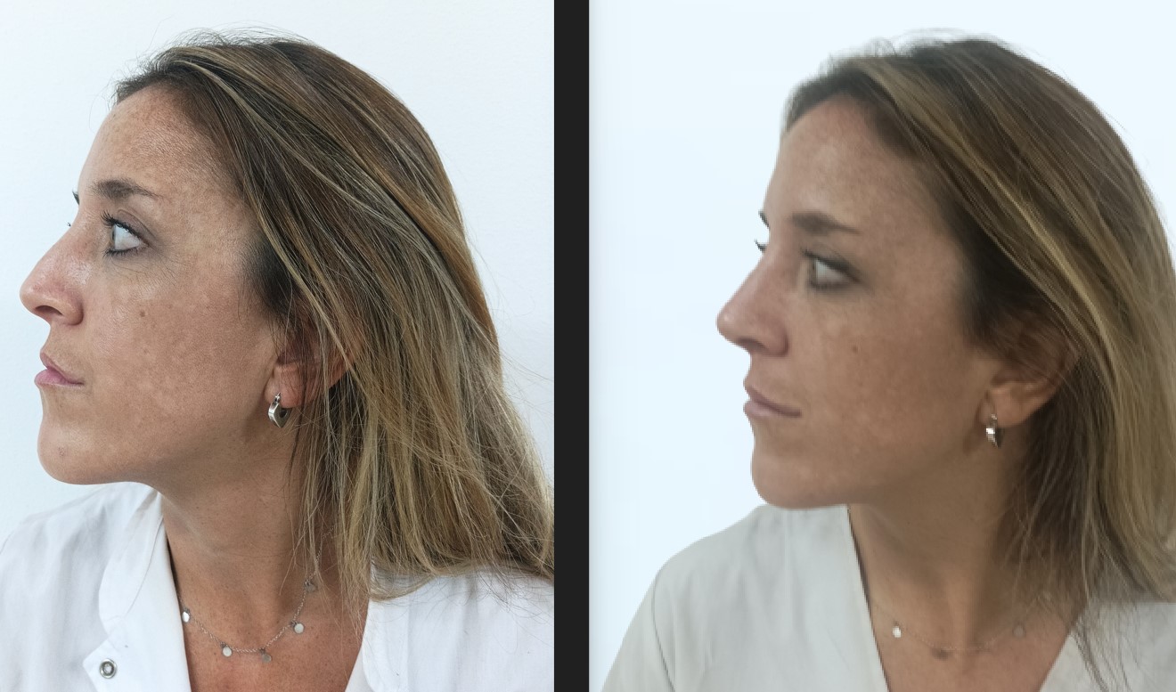 Rinomodelación con Ácido Hialurónico | Dermatología y Estética